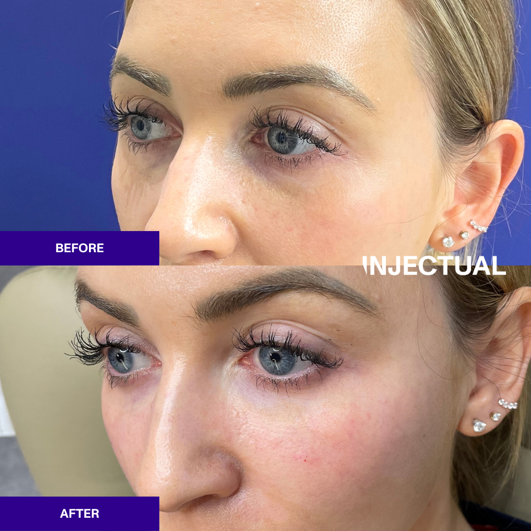 Ameela® (Nucleadyn®) Under Eye Treatment | Injectual